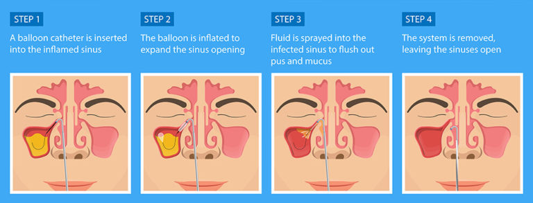 10 Signs You Have a Sinus Infection - Chicago ENT