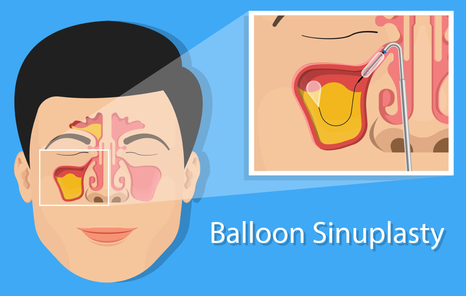 6 Signs You Could Be a Good Candidate for Balloon Sinuplasty - Chicago ENT